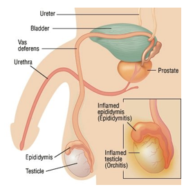 Bijbalontsteking (Epididymitis) - GGD Amsterdam